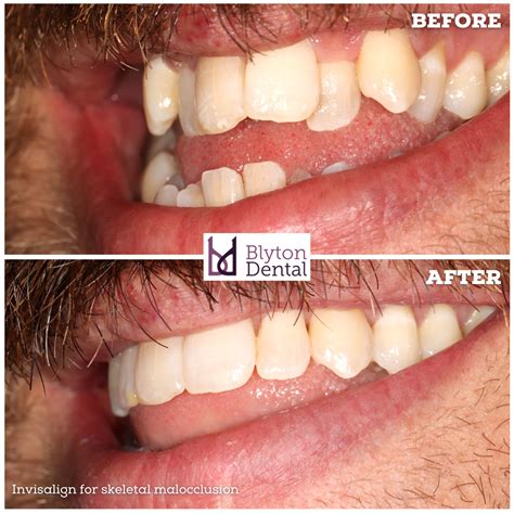 Invisalign For Skeletal Malocclusion — Blyton Dental