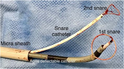 Late Extraction Of An Embolized Leadless Pacemaker From The Right
