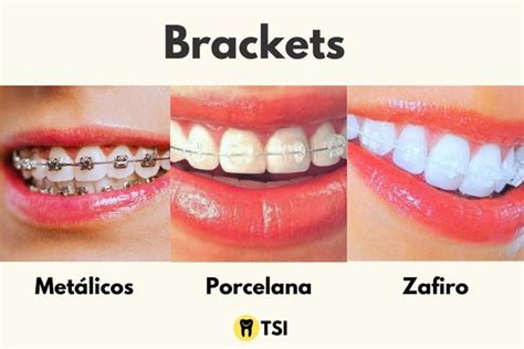 Pros Y Contras De Los Brackets Linguales