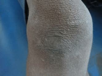 View Atrophic Scars Ehlers Danlos Background Just Sharing
