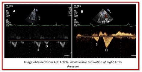 Hepatic Vein Doppler Waveforms In Echo A Guide To Right Heart Hemodynamics Cardioserv