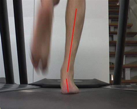 The Nonsensical Understanding Of Overpronation Running Research