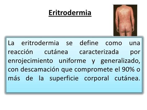 Eritrodermiavitiligoalopeciatricotilomania