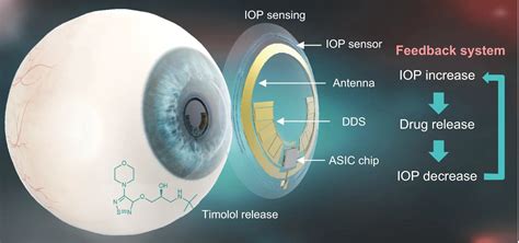 Glaucoma Diagnosis