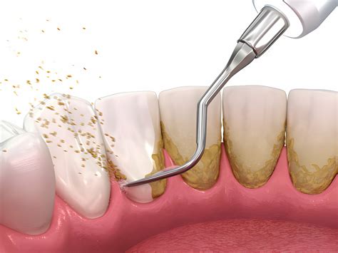 Scaling And Root Planing Tru Dental