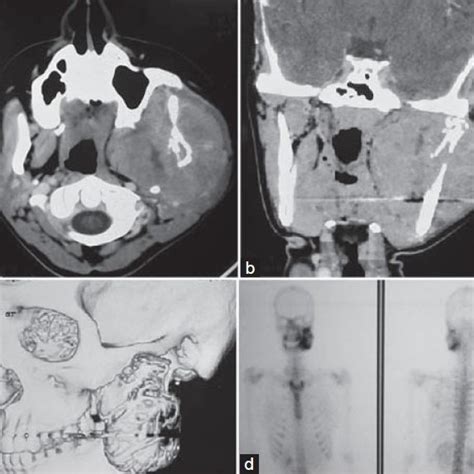 A Intraoperative Photograph Following En Bloc Resection Of The Tumor