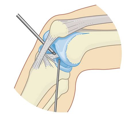 Cross Section Biomedical Illustration Of Inside The Knee Joint During