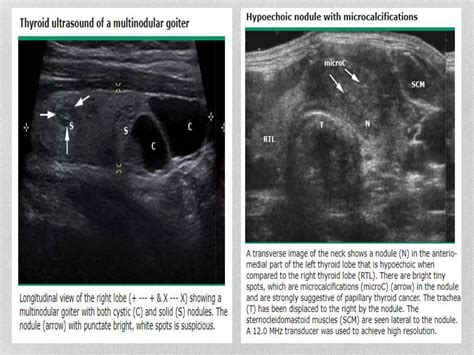 Approach To Thyroid Nodule Pptx