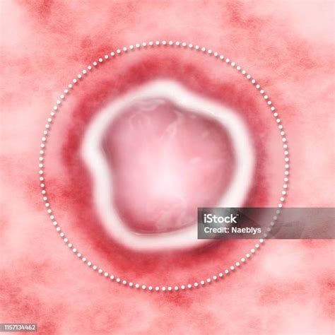 Stomatitis Aphthous Adalah Kondisi Umum Yang Ditandai Dengan Pembentukan Berulang Ulkus Mulut