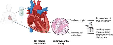 Diagnosing Immune Checkpoint Inhibitor Induced Myocarditis Insights Challenges And