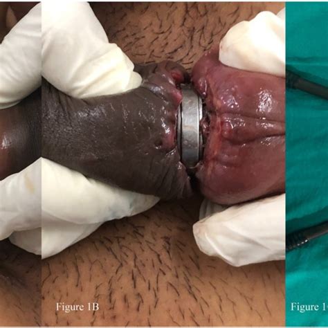 A Shows The Metallic Ring Encircling The Coronal Sulcus At Dorsal