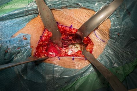 Total Hip Replacementdirect Anterior Approach Anthology Stem And R3 Cupsmith And Nephew