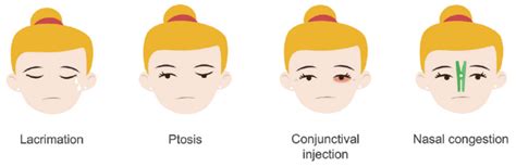 Trigeminal Autonomic Cephalalgias • Litfl • Neurology Library