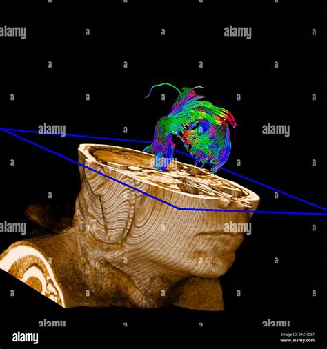 Brain Tumour Coloured 3d Diffusion Tensor Imaging Dti And Magnetic Resonance Imaging Mri