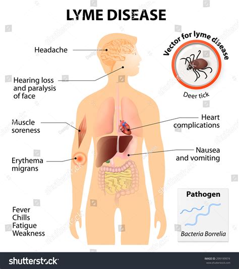 Lyme Disease Symptoms Causes And Treatment By Dr Radhika Amulraj