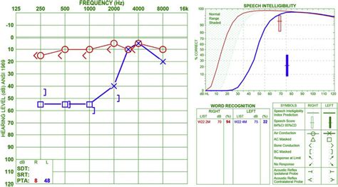 Audiology Report Of Our Patient Showing Significant Decrease In Hearing