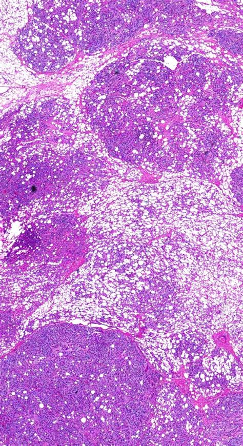 Pathology Of Chondroid Lipoma Tie Dye Wallpaper Pathology Rocks And