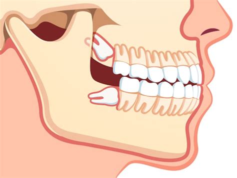 Шүд эрүү нүүр амны гажиг үүсэх шалтгаан Индранил Дентал Менежмент