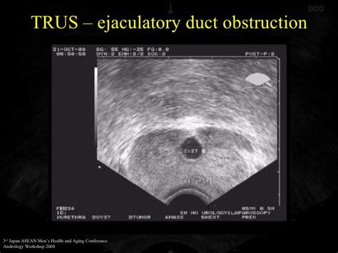 Trus In Evaluation Of Male Infertility