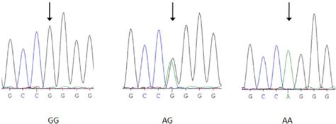 Agt G 6a Polymorphism Genotyping By Direct Sequencing The Arrows