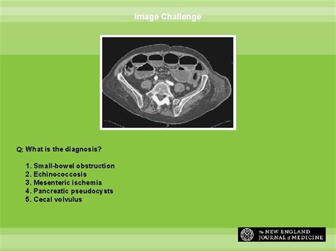 Recurrent Anterior Subcoracoid Dislocation With Hillsachs Deformity Of