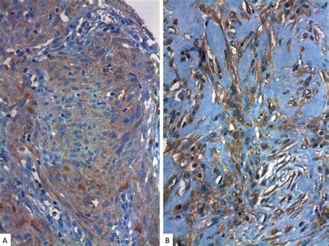 Gist Pkcθ Immunostaining A Low Power View Showing An Epithelioid Download Scientific