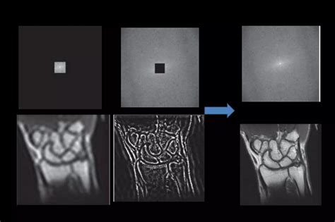 K Space And Parallel Imaging Pptx Medical Tests Medical Health