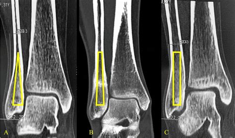 The Proposed Classification Based On The Observation Of The Distal