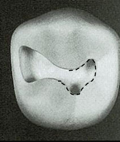 Unit 11 Class Ii Preparation And Restoration With Amalgam Flashcards Quizlet