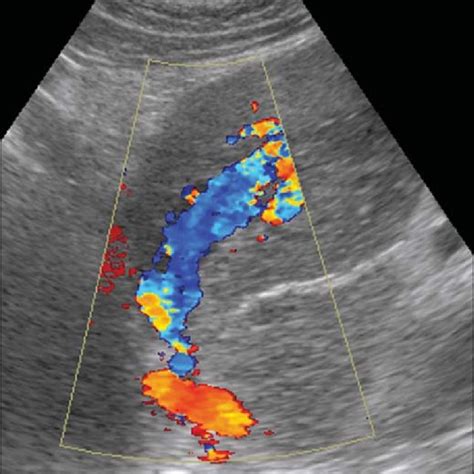 Pdf B Flow Imaging Of The Hepatic Vasculature Correlation With Color Doppler Sonography