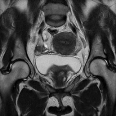 Urethral Diverticula Radiology Key