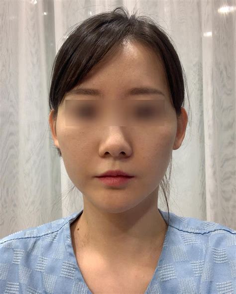 입체성형외과의원 광대 원인에 따라 진행되는 맞춤수술 얼굴의 가로폭을 결정짓는 옆광대 얼굴의 굴곡을