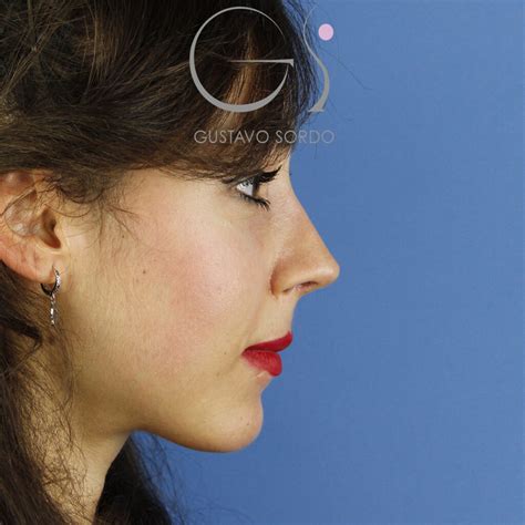 【before And After Blepharoplasty 50 Real Photos 2025】