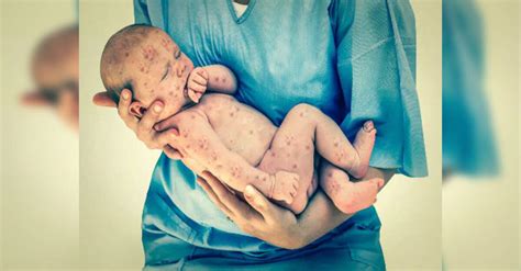 Sydney Aus State Issues Public Health Alert After Detection Of Measles Ethealthworld