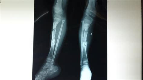 Surgeries In Bohra Speciality Hospital Tibialization Of Fibula In Ch Om