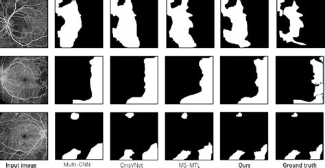 Comparison Of Dr Lesion Segmentation Results Between Our Proposed Model