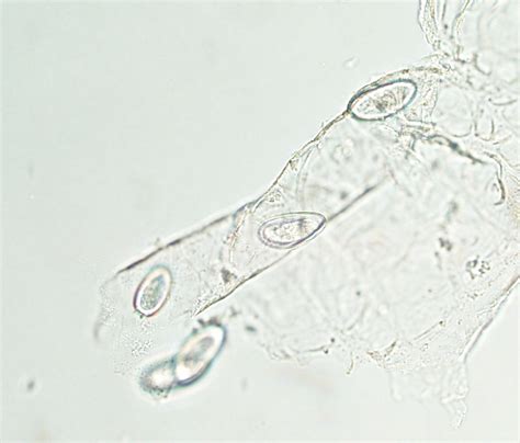 Pinworm Scotch Tape Test