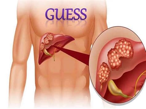 Approach To Patients With High Liver Function Test Pptx Medical Health