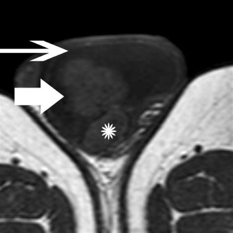 Transverse T1 Weighted Image Depicts A Multilobular Left Scrotal Mass Download Scientific