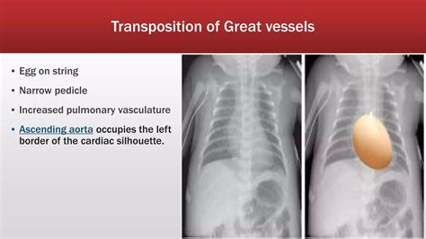 Cardiac X Ray Pptx
