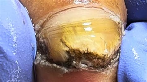Thick Onychomycosis Covered With A Layer Of Black Mud Underneath