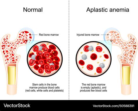 Aplastic Anemia Royalty Free Vector Image Vectorstock