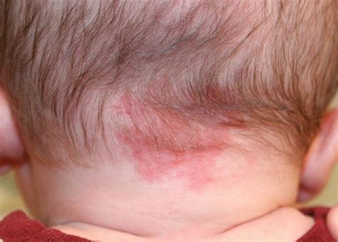 Otherwise Called Capillary Nevus Simplex Or Stork Bites These Are