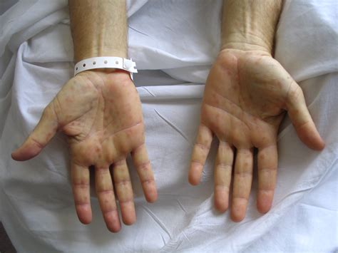 Early Syphilis In Men