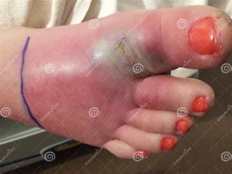 Abscess Gangrene And Cellulitis Of Left Foot Stock Image Image Of Medicine Atopic 332775471