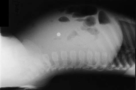 Lateral View Radiograph Shows Dilated Bowel Loops And Paucity Of The