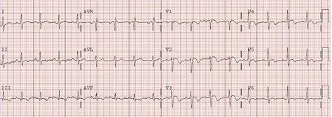 Dr Smith S ECG Blog Anterior T Wave Inversion Due To Pulmonary Embolism
