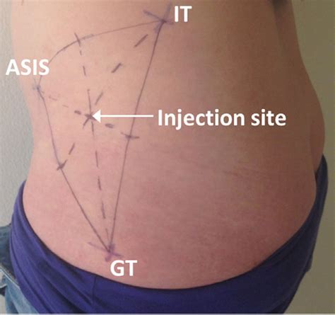 Figure 1 From Comparison Of The G And V Methods For Ventrogluteal Site