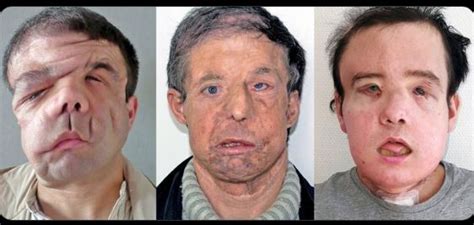 Jerome Hamon Pionier In Dubbele Gezichtstransplantatie Overleden