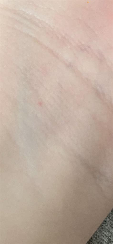 Been Getting Tiny Flat Red Spots On Arms Now Today I Woke Up With A Red